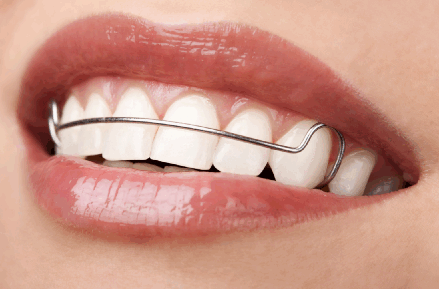 The Importance of Retainers After Braces - Pioneer Orthodontics